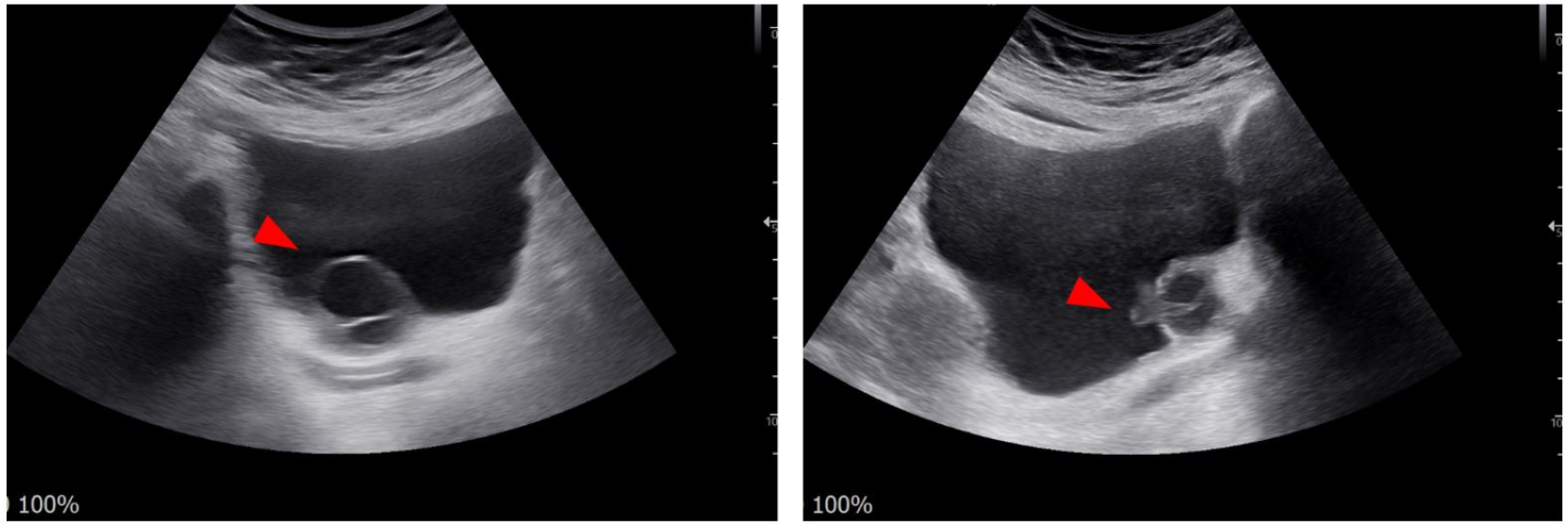 A Surgical Case Report of Female Brunn’s Cyst causing Bladder neck ...